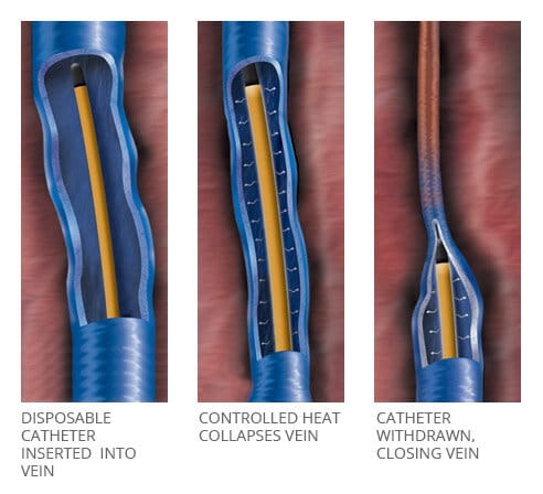 Endovenous Radiofrequency Ablation Ocala FL - Vein Specialists